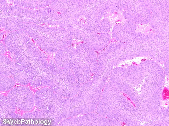 Inverted Papillary Uroth. CA, Low-Grade : Microscopic