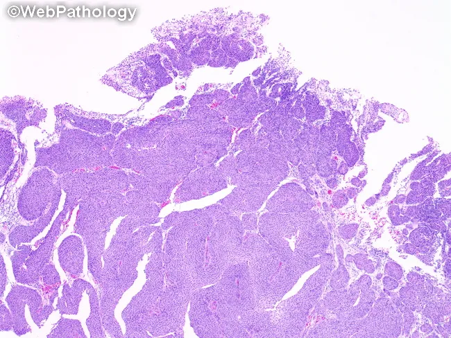 Inverted Papillary Uroth. CA, High-Grade : Introduction