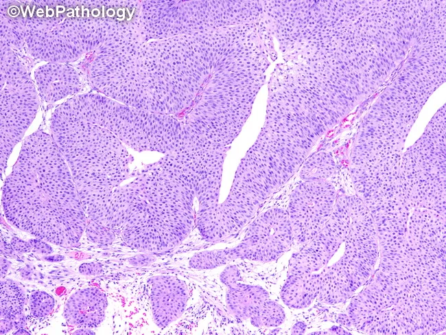 Inverted Papillary Uroth. CA, High-Grade : Microscopic