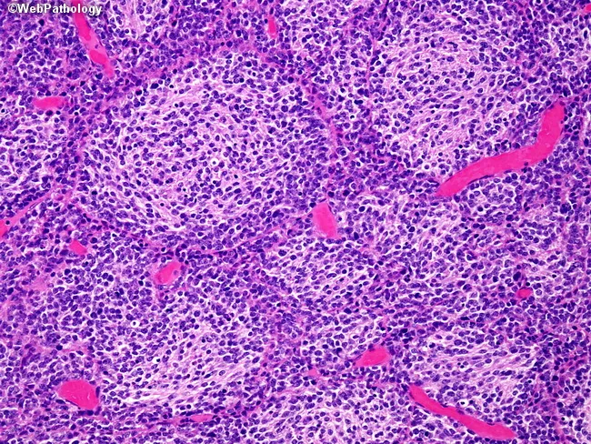 medulloblastoma pathology outlines