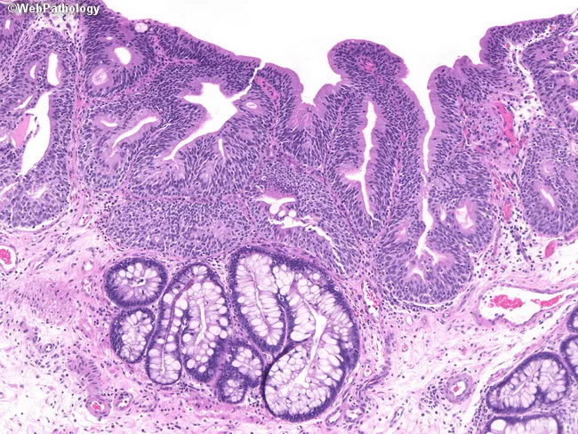 Intestinal Metaplasia