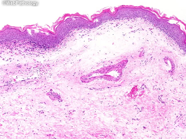 Keratinizing Squamous Metaplasia