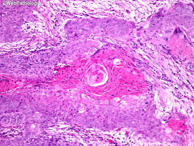 Squamous Differentiation in Urothelial Carcinoma