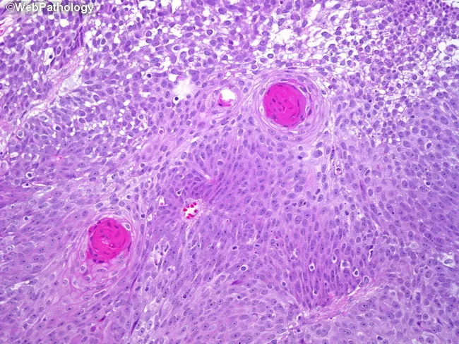 Squamous Differentiation in Urothelial Carcinoma