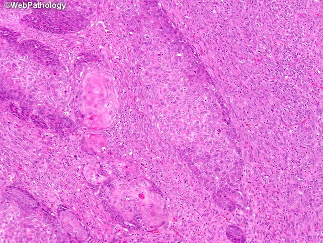 Squamous Differentiation in Sarcomatoid Urothelial Carcinoma
