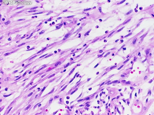 Post-operative Spindle Cell Nodule