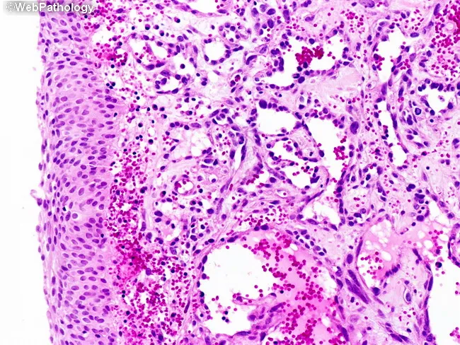 Angiosarcoma of Bladder
