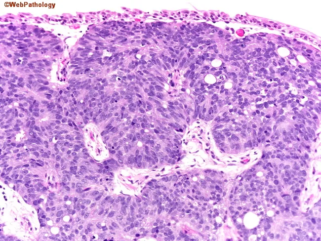 Metastatic Prostate Cancer in Bladder