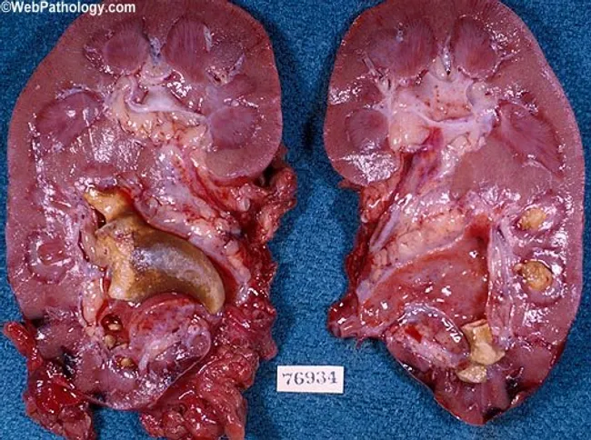 staghorn bladder stone