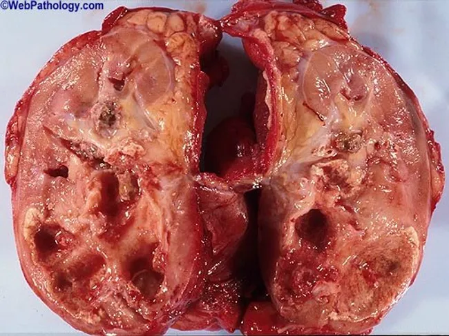 xanthogranulomatous pyelonephritis pathology