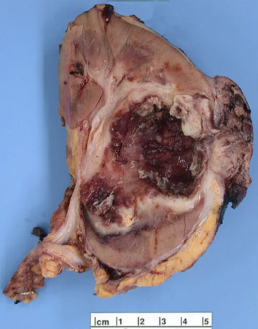 xanthogranulomatous pyelonephritis pathology
