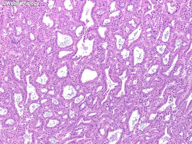 Oncocytoma Tubulocystic Pattern