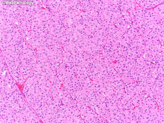 Oncocytoma : Solid Pattern