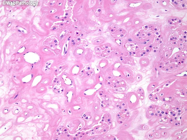 Oncocytoma : Hyalinized Stroma
