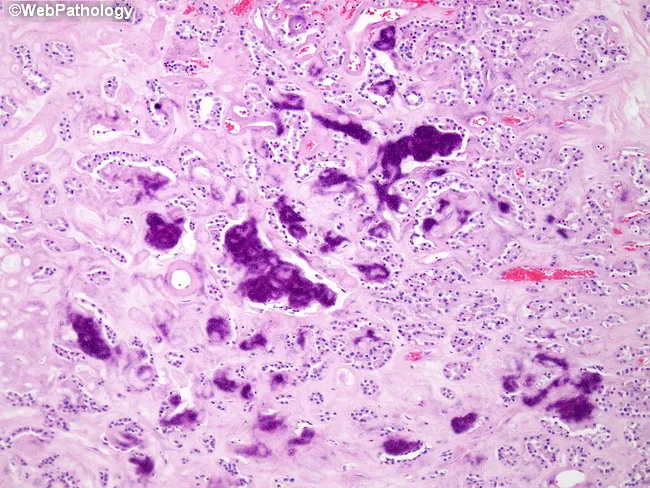 Oncocytoma : Calcified Stroma