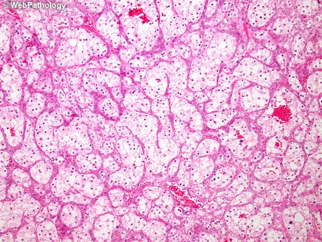 Clear Cell Renal Cell Carcinoma
