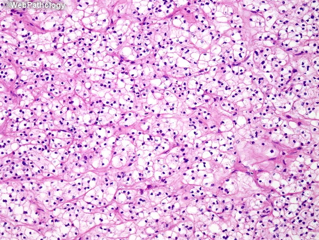 RCC, Fuhrman Nuclear Grade 1