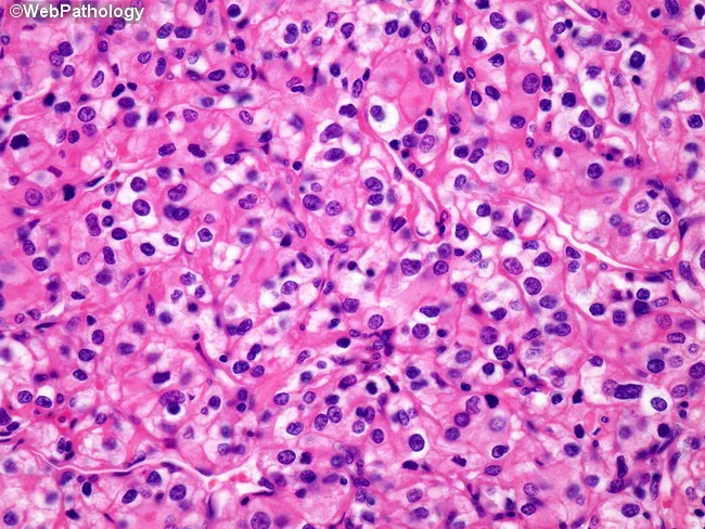 RCC, Fuhrman Nuclear Grade 2