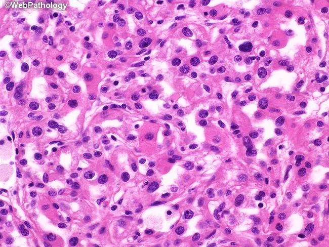 RCC, Fuhrman Nuclear Grade 3