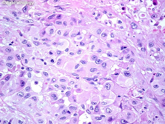 RCC, Fuhrman Nuclear Grade 4