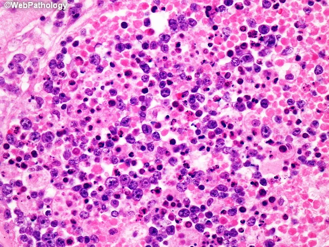 Primary CNS Lymphoma