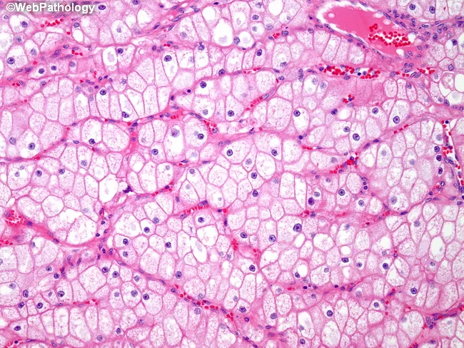 Chromophobe Renal Cell Carcinoma