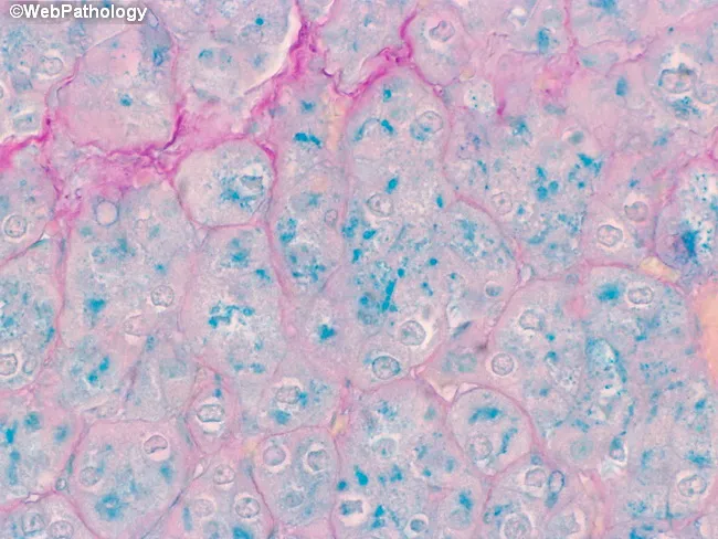 Chromophobe Renal Cell Carcinoma : Colloidal Iron Stain