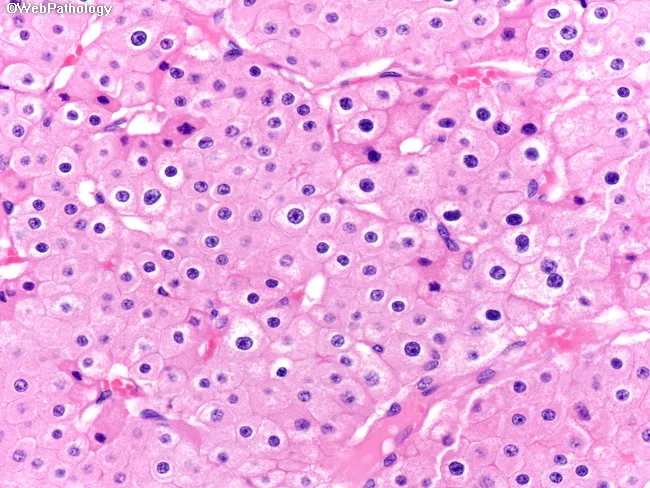 Chromophobe Renal Cell Carcinoma : Eosinophilic type