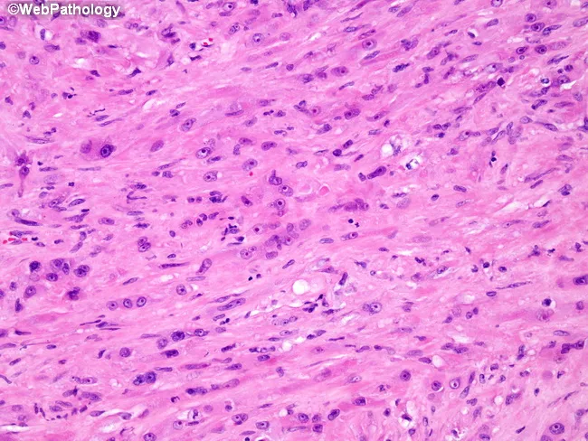Sarcomatoid Renal Cell Carcinoma