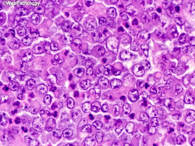 Rhabdoid Tumor : Microscopic Features