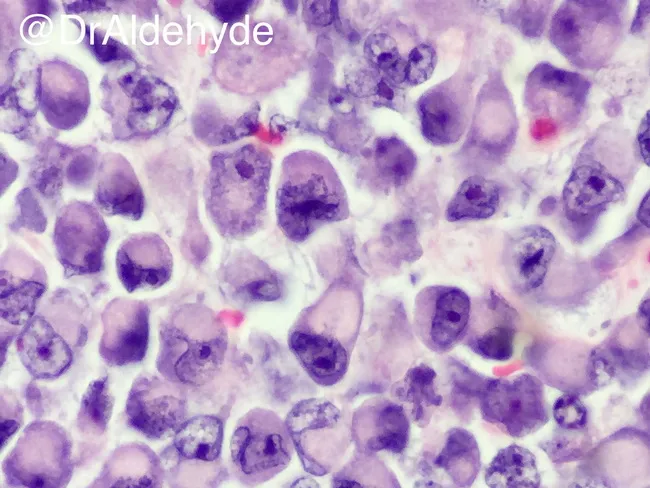 Rhabdoid Tumor : Microscopic Features