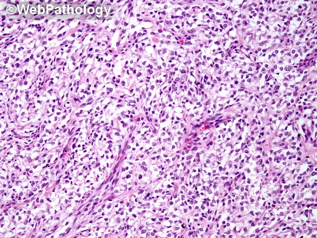 Clear Cell Sarcoma of Kidney : Introduction