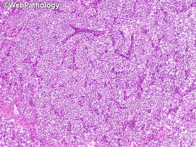 Clear Cell Sarcoma of Kidney : Clinical Features