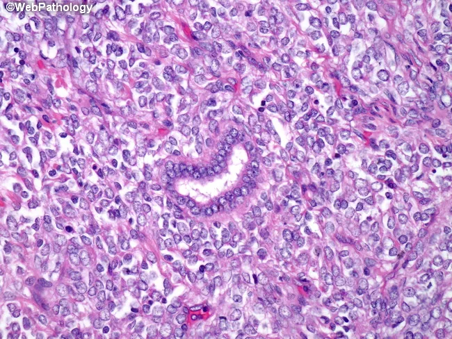 Clear Cell Sarcoma of Kidney