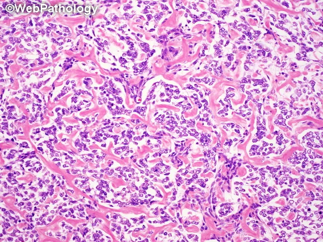 Clear Cell Sarcoma of Kidney : Sclerosing Patterns