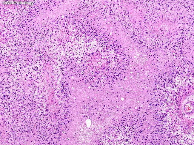 Glioblastoma : Pseudopalisading