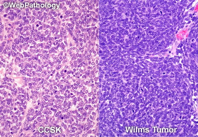 Clear Cell Sarcoma of Kidney : Differential