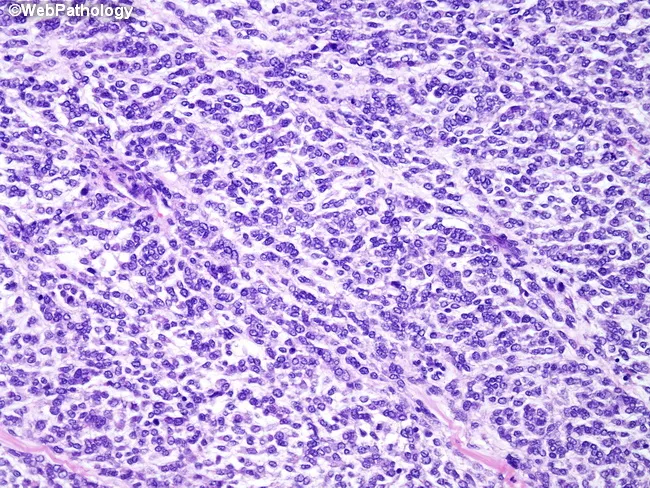 Clear Cell Sarcoma of Kidney : Metastases