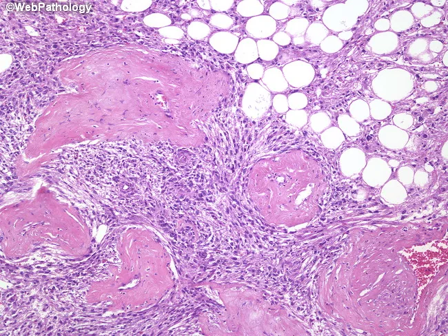 Angiomyolipoma