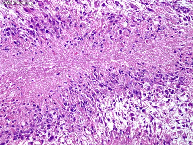Glioblastoma : Pseudopalisading