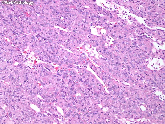 Juxtaglomerular Cell Tumor