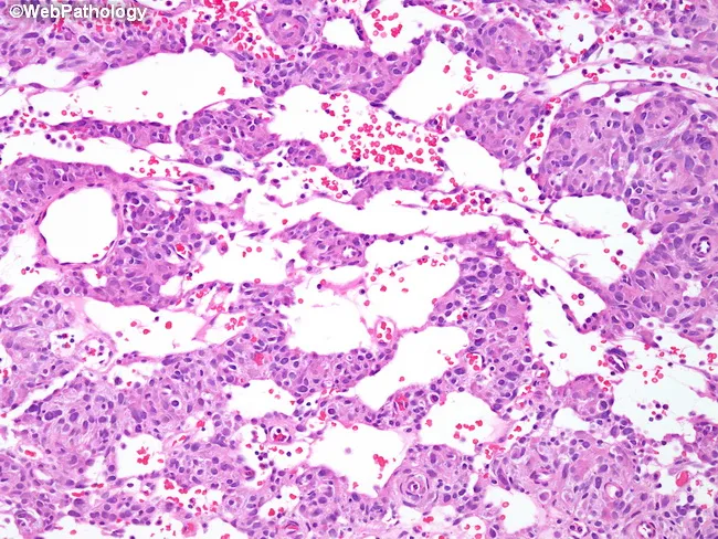 Juxtaglomerular Cell Tumor
