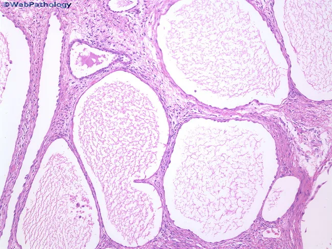 Multicystic Nephroma