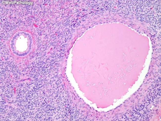 Mixed Epithelial & Stromal Tumor