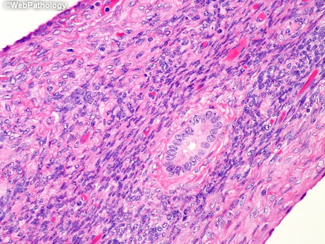 Mixed Epithelial & Stromal Tumor