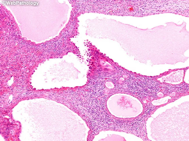Mixed Epithelial & Stromal Tumor