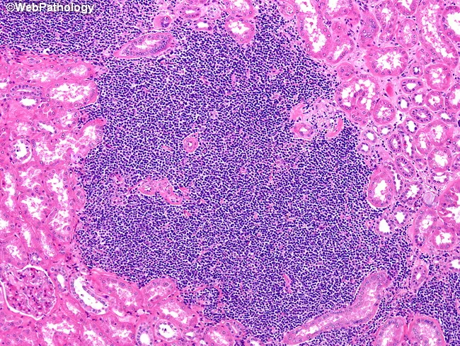 Mantle Cell Lymphoma