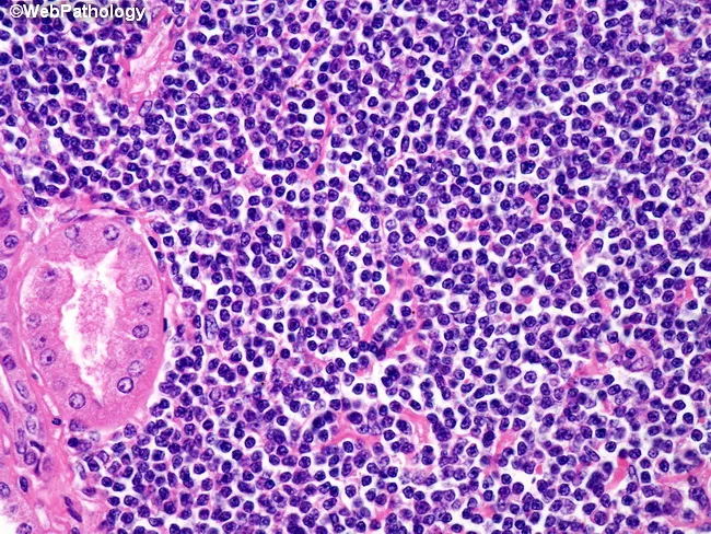 Mantle Cell Lymphoma