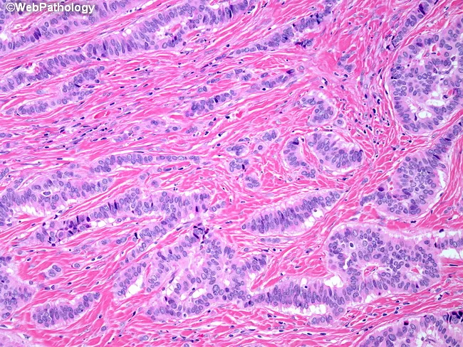 Well-Differentiated Neuroendocrine Tumor