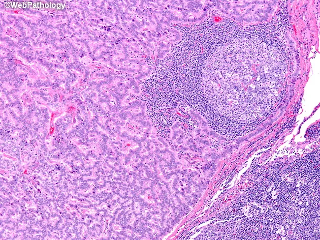 Well-Differentiated Neuroendocrine Tumor